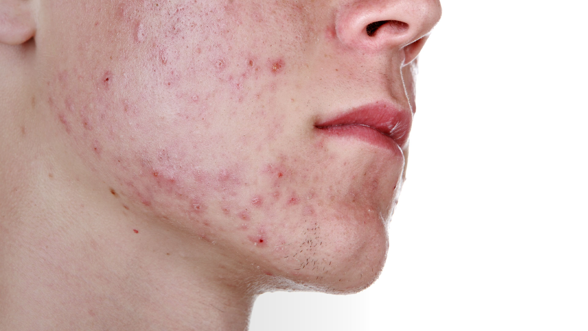 Effective Acne Treatment in Geelong | GVSL