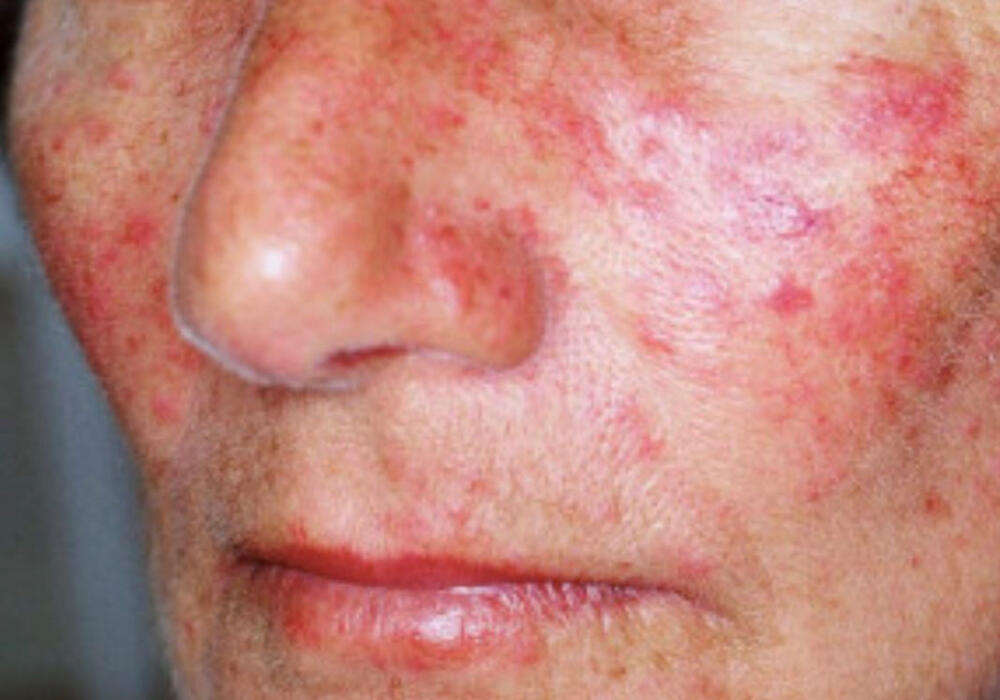 Broken Capillaries & Rosacea Symptoms | Geelong Veins Skin & Laser