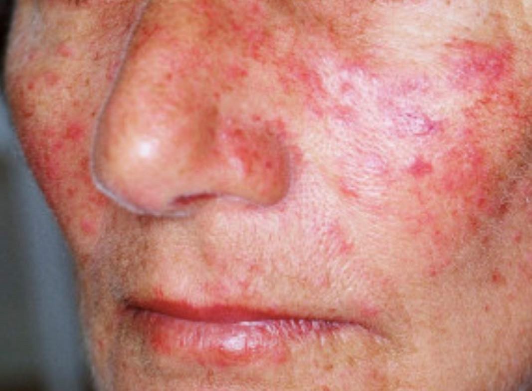 Broken Capillaries & Rosacea Symptoms | Geelong Veins Skin & Laser