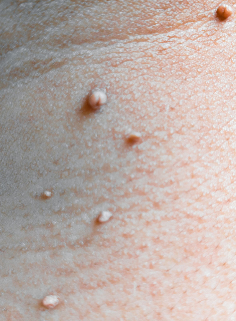 Skin Tags | Geelong Veins Skin & Laser