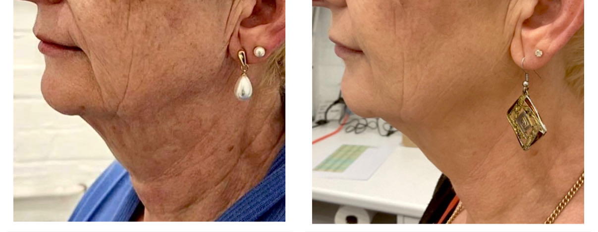 TriLift Treatment for Facial Toning & Rejuvenation | GVSL